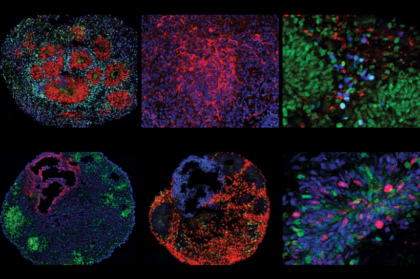 An Autism Mom’s Cancer Journey Continues – Autism Love | Autism QIA